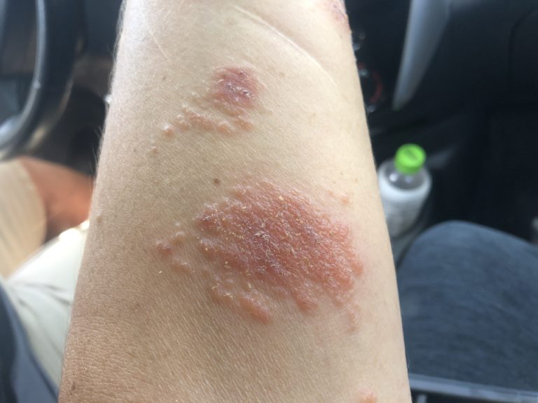 Scabies…the parasite from hell. – Embracing Your Joy